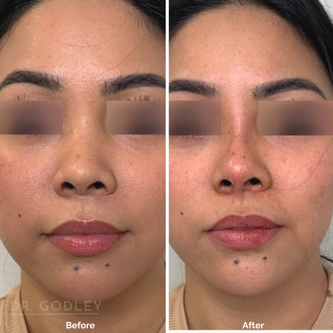 Non-Surgical Nose Job - Conquer 180